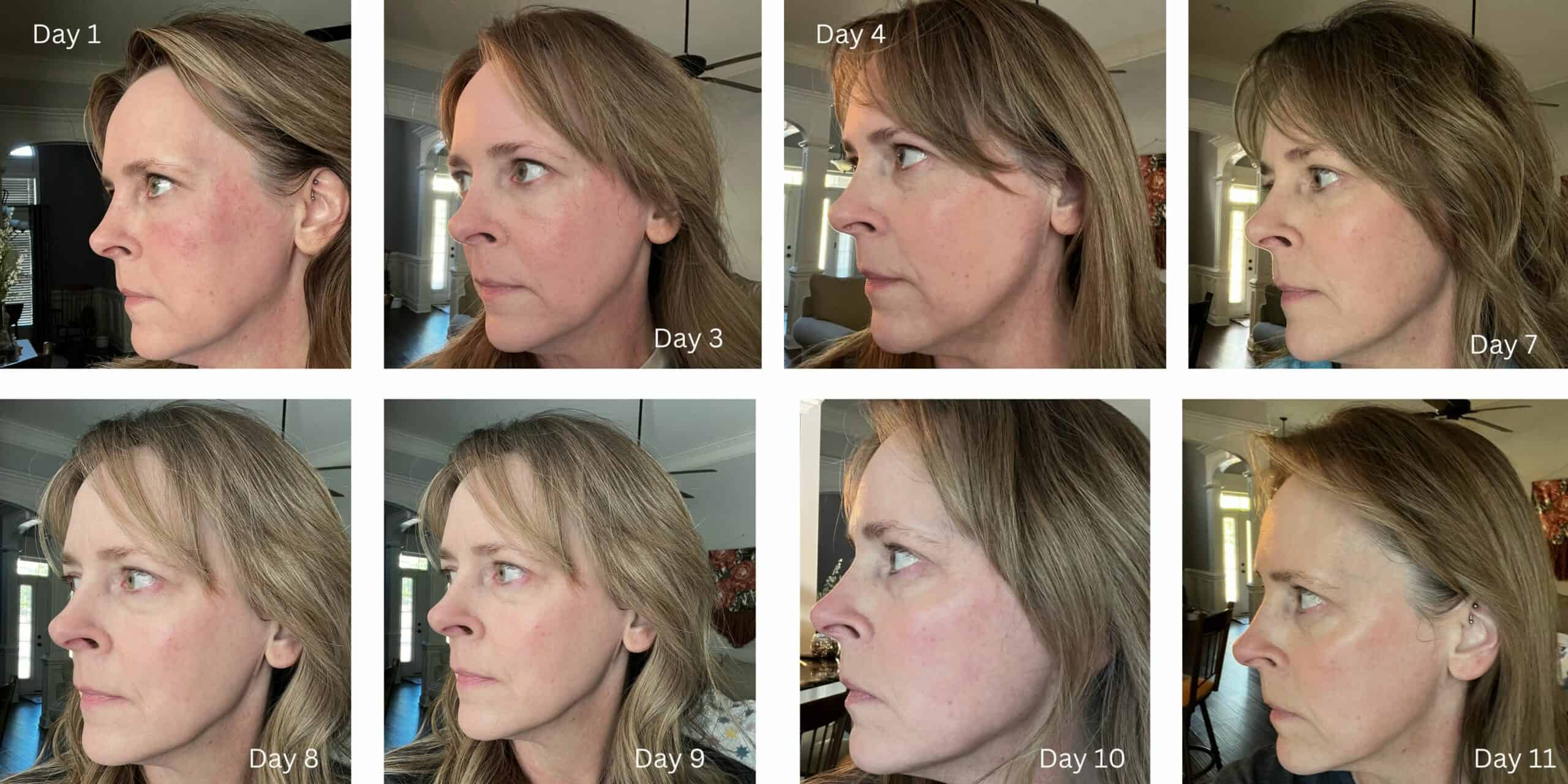 I Tried the MOXI Laser Treatment in Nashville (REVIEW)